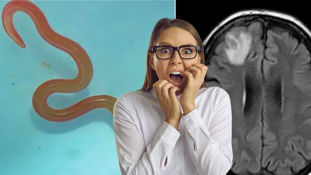 Doctors Find 8-Centimetre Worm in Aussie Woman’s Brain